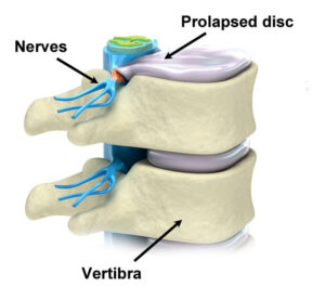 How to Treat a Prolapsed Disc: Best Recovery Methods