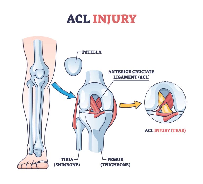 How to Prevent ACL Injuries: Tips for Stronger Knees