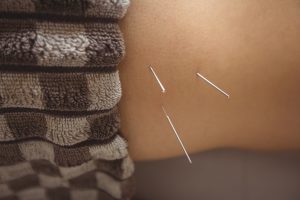 How Does Dry Needling Therapy Work? Benefits and Risks